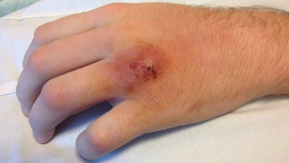 Staph infection secrets review – dr. hubert walinski’s treatment