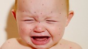 27 common newborn baby skin problems parents must know