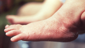 27 common newborn baby skin problems parents must know