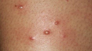 27 common newborn baby skin problems parents must know