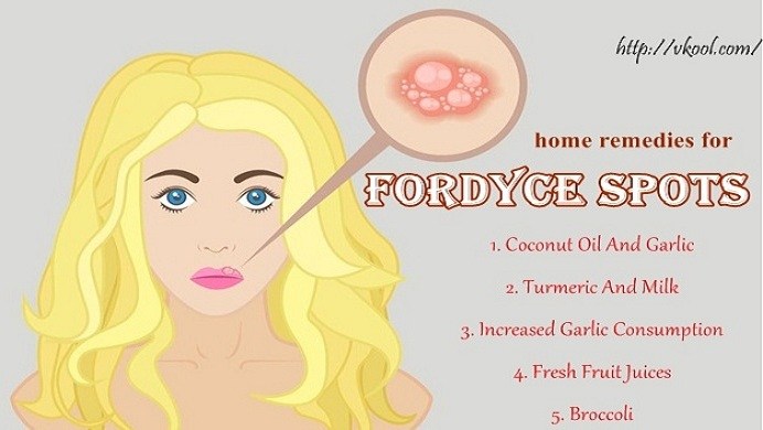 Top 13 Natural Home Remedies For Fordyce Spots Top 13 Natural Home Remedies For Fordyce Spots